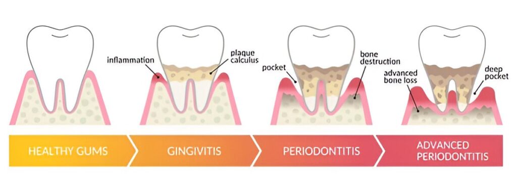 Periodontal Treatment: Prevent & Treat Gum Disease Effectively